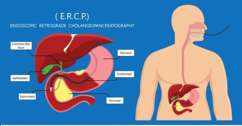 Bile Duct Stones After Gallbladder Removal | Dr. Ksheetij Kothari